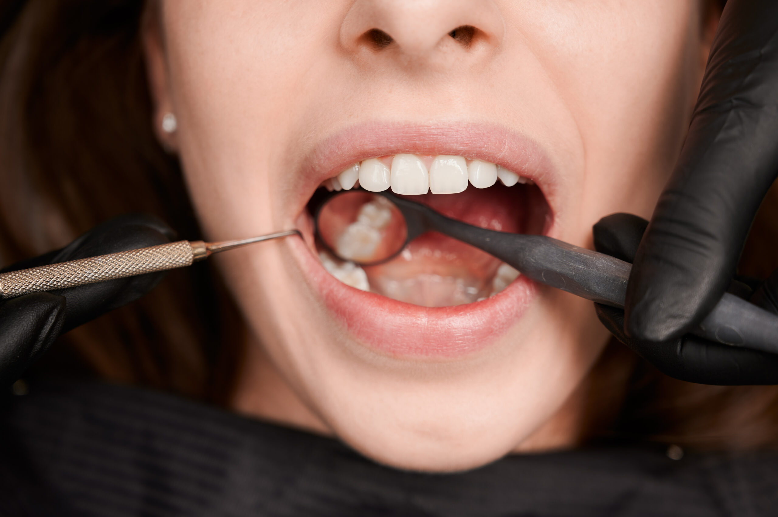 Safe Mercury Amalgam Removal Technic (SMART) - Medtopia Holistic Dentistry